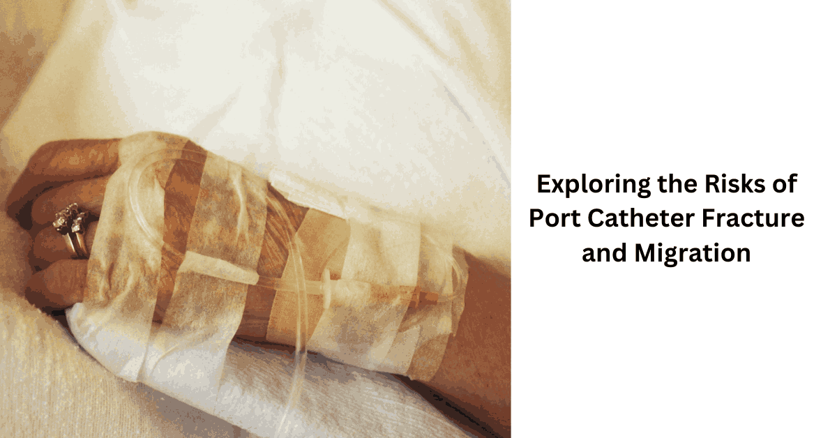 Exploring the Risks of Port Catheter Fracture and Migration - myeclass